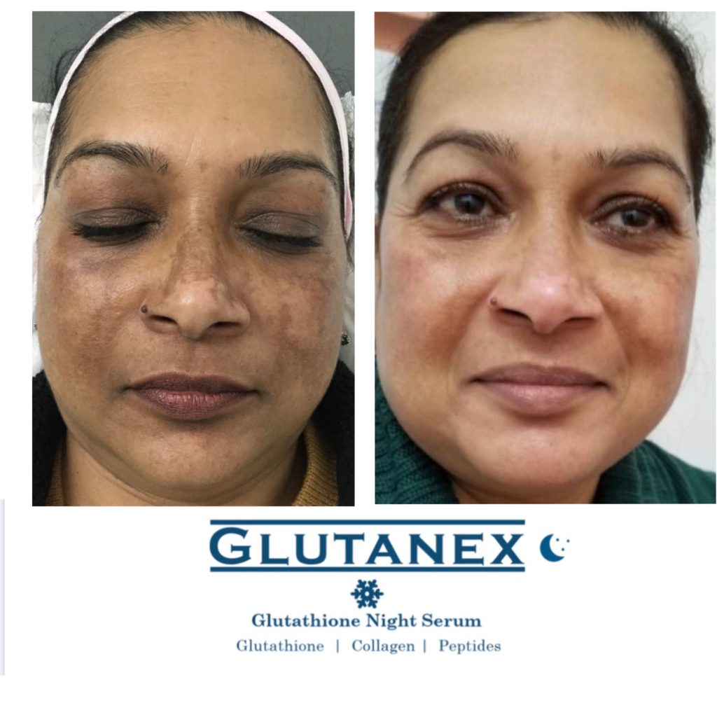 Glutanex Whitening Mask Booster Kit - Glutanex
